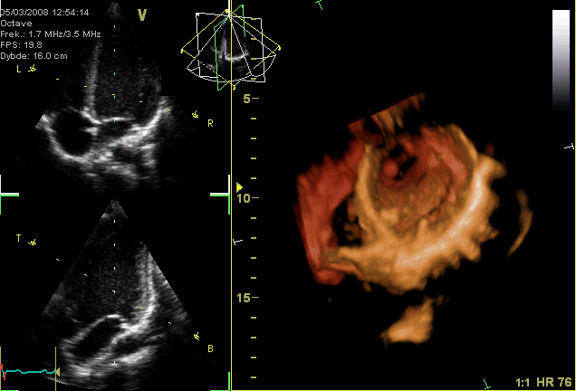What is a transthoracic echocardiogram (TTE)? – Australian Heart