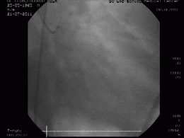 What is a coronary angiogram (angio)? – Australian Heart