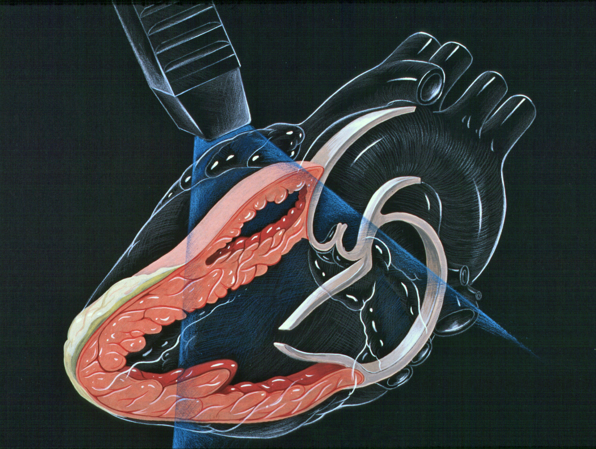 What is a transthoracic echocardiogram (TTE)? – Australian Heart