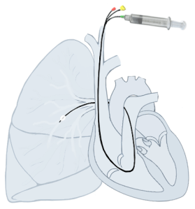 What is right heart catheterisation? – Australian Heart