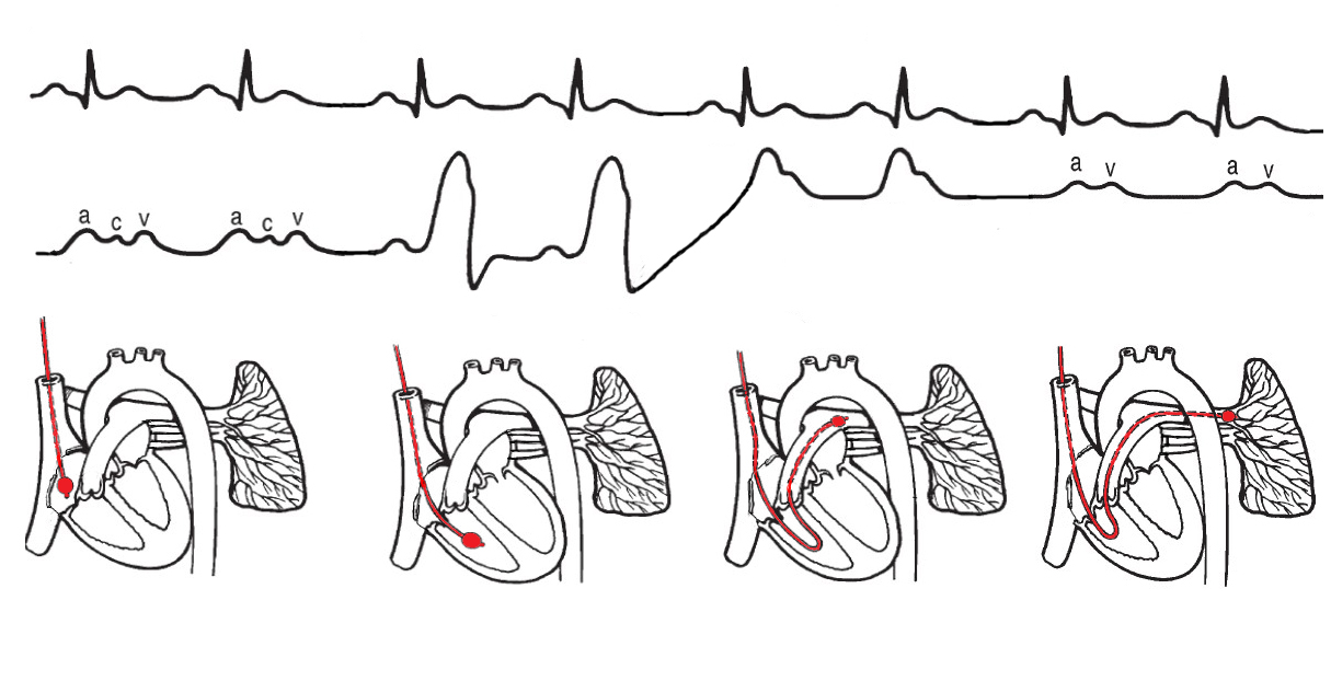 What is right heart catheterisation? – Australian Heart