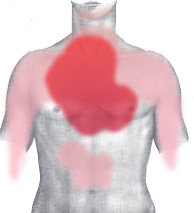 What are the symptoms of a heart attack? – Australian Heart